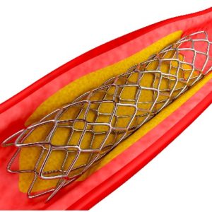 GNY :: Life-saving coronary stents have been made affordable